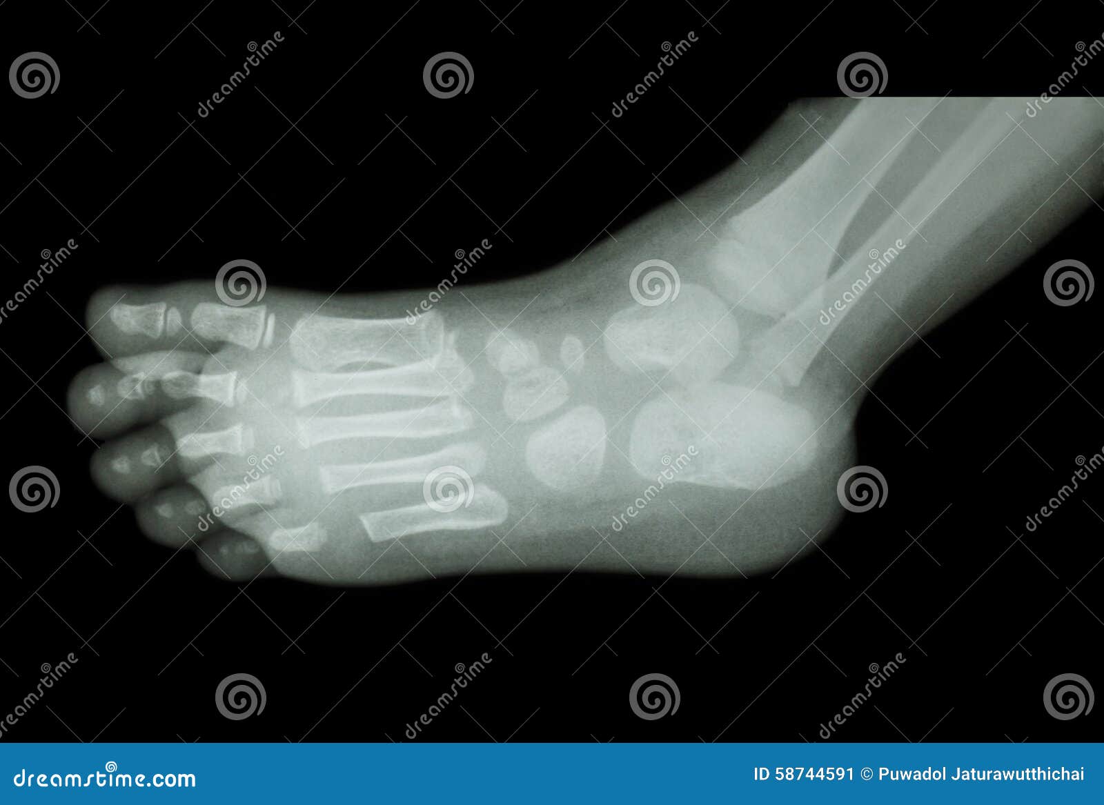 Film X-ray of Child S Foot ( Side View ) ( Lateral ) Stock Image ...