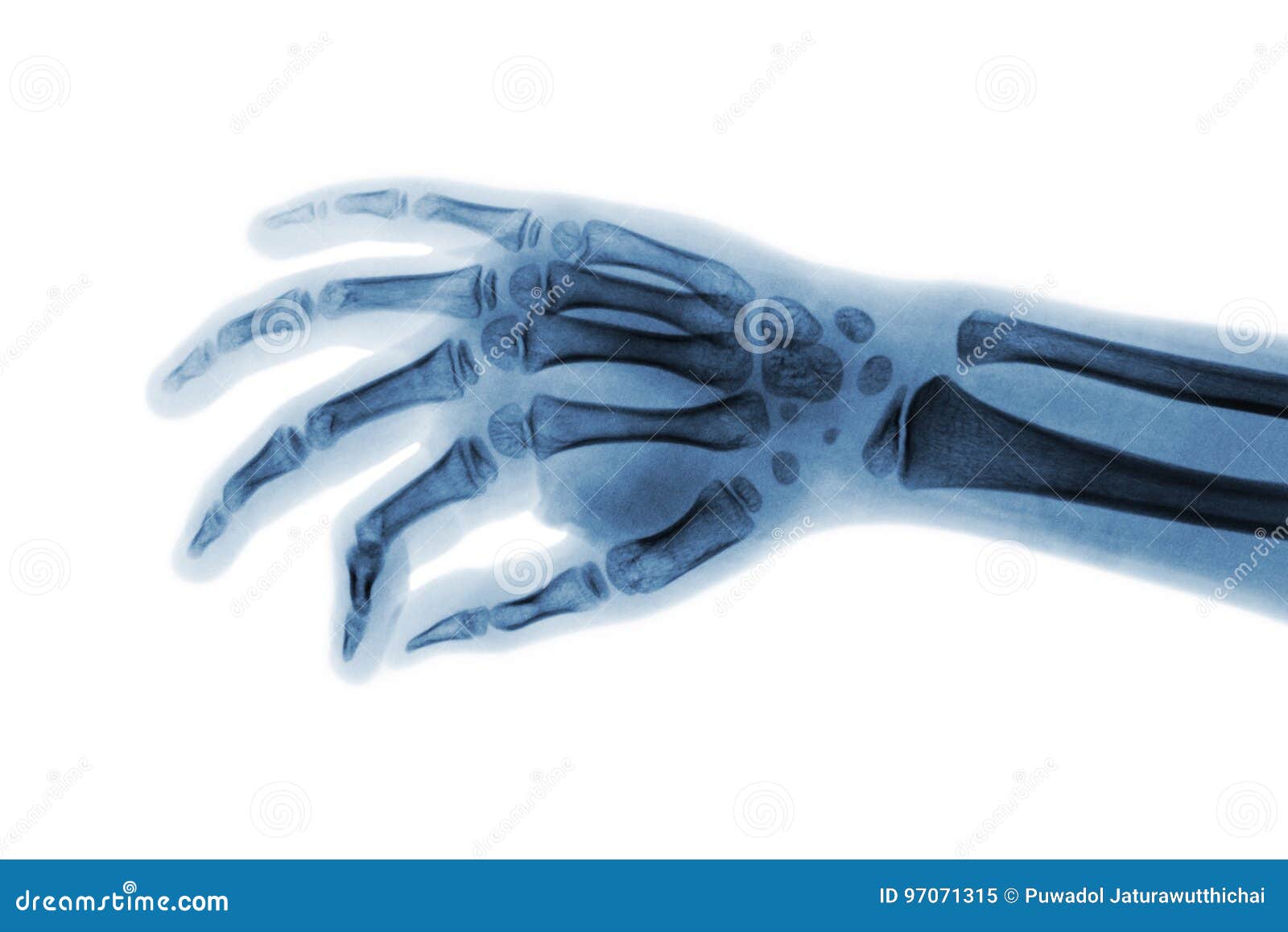 Film X-ray Hand of Child . Oblique View Stock Image - Image of baby ...