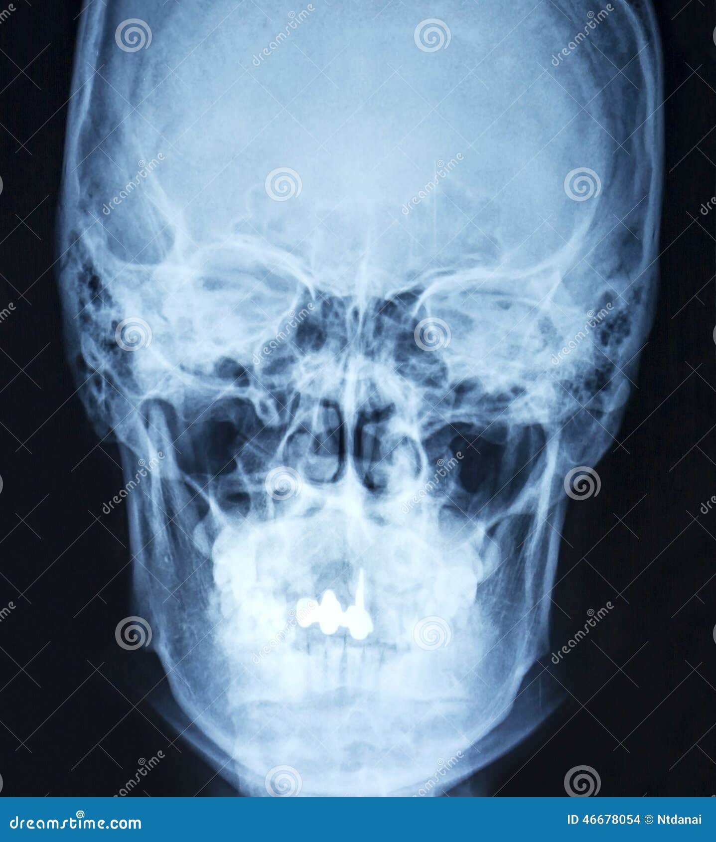 X Ray Head Front