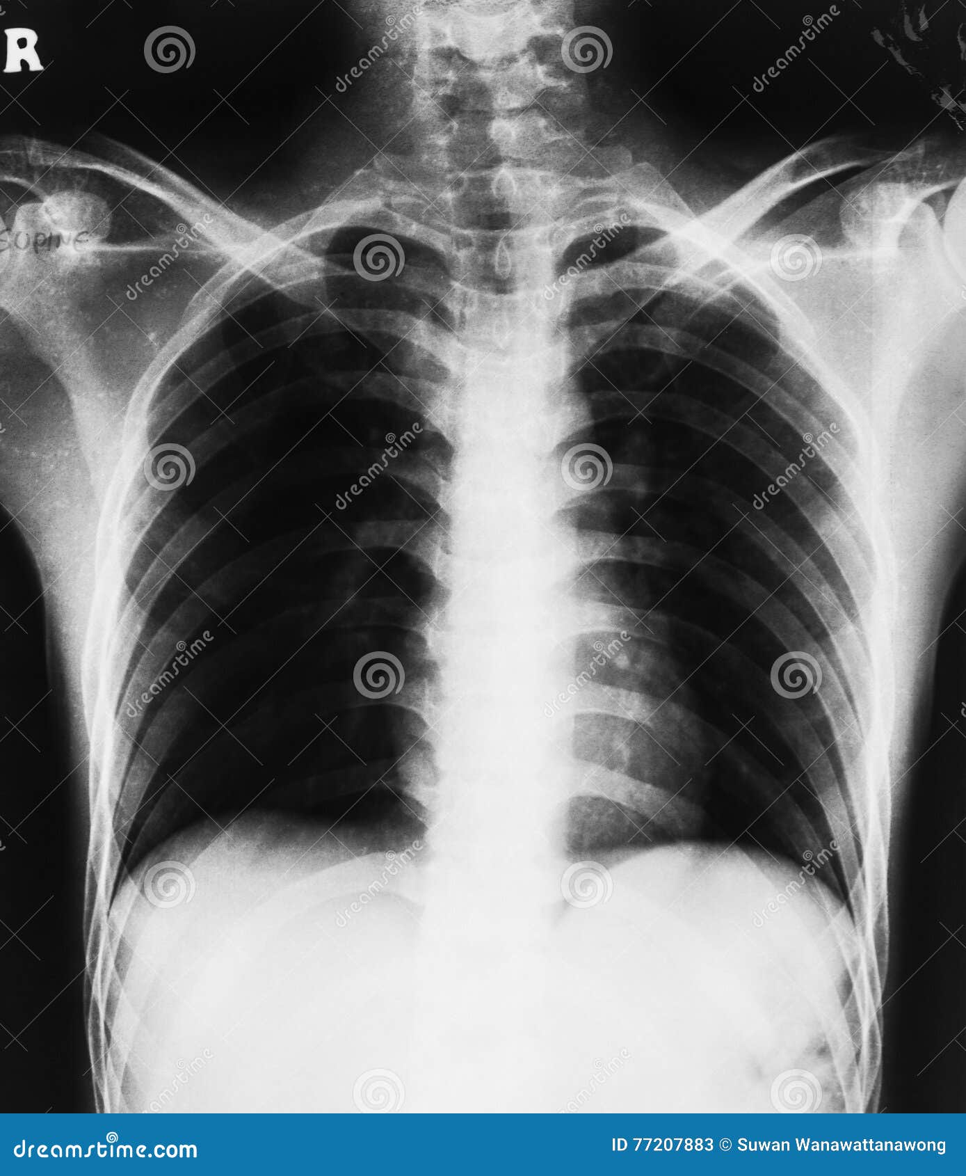 Film X-ray image of rib stock image. Image of spine, joint - 77207883