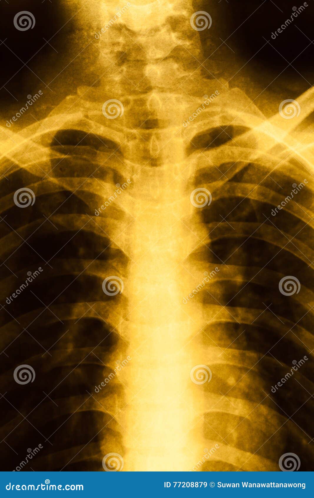 Film X-ray image of rib stock image. Image of body, medical - 77208879
