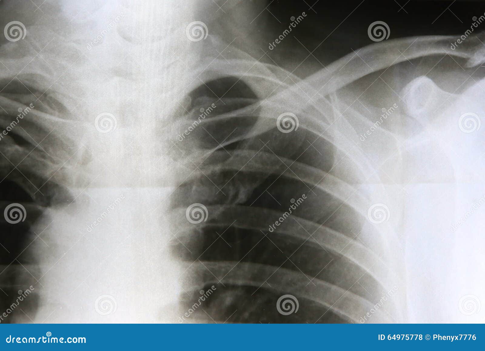 Film x-ray left clavicle stock photo. Image of care, clivicle - 64975778