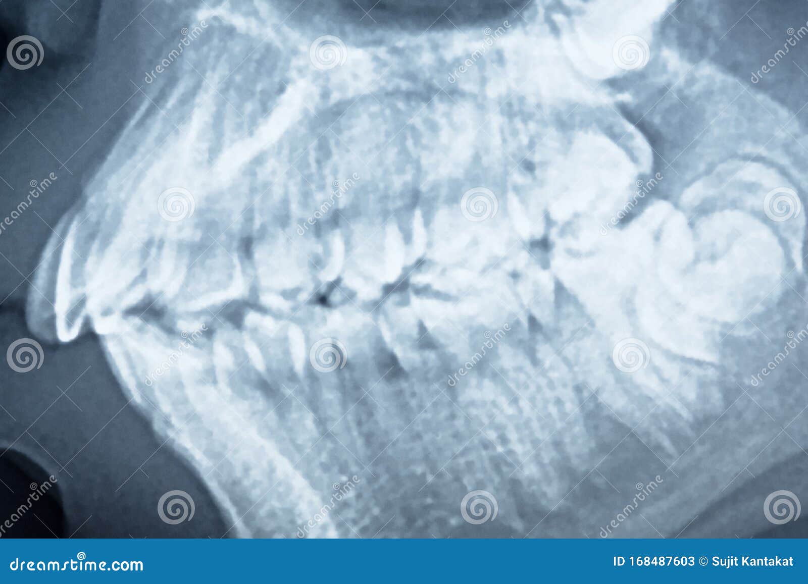 Film x-ray of a mouth. stock image. Image of head, roentgenogram ...