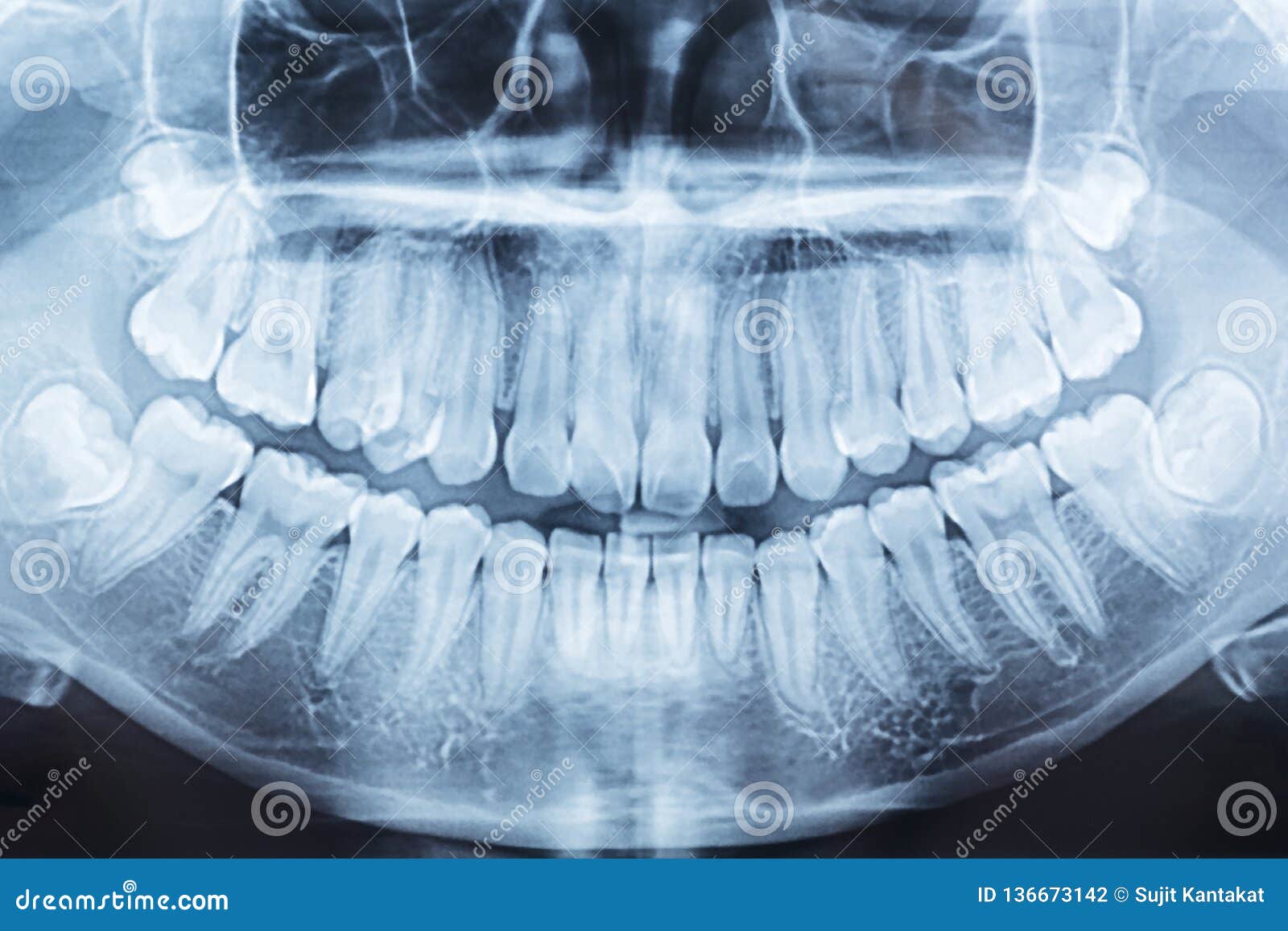 Film x-ray of a mouth. stock photo. Image of medical - 136673142