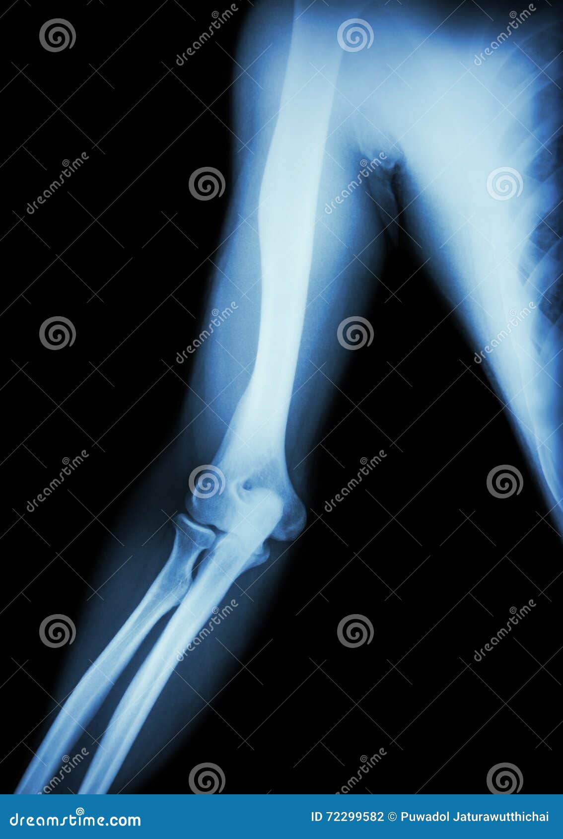 Film X-ray of Normal Arm , Elbow and Forearm Stock Photo - Image of ...