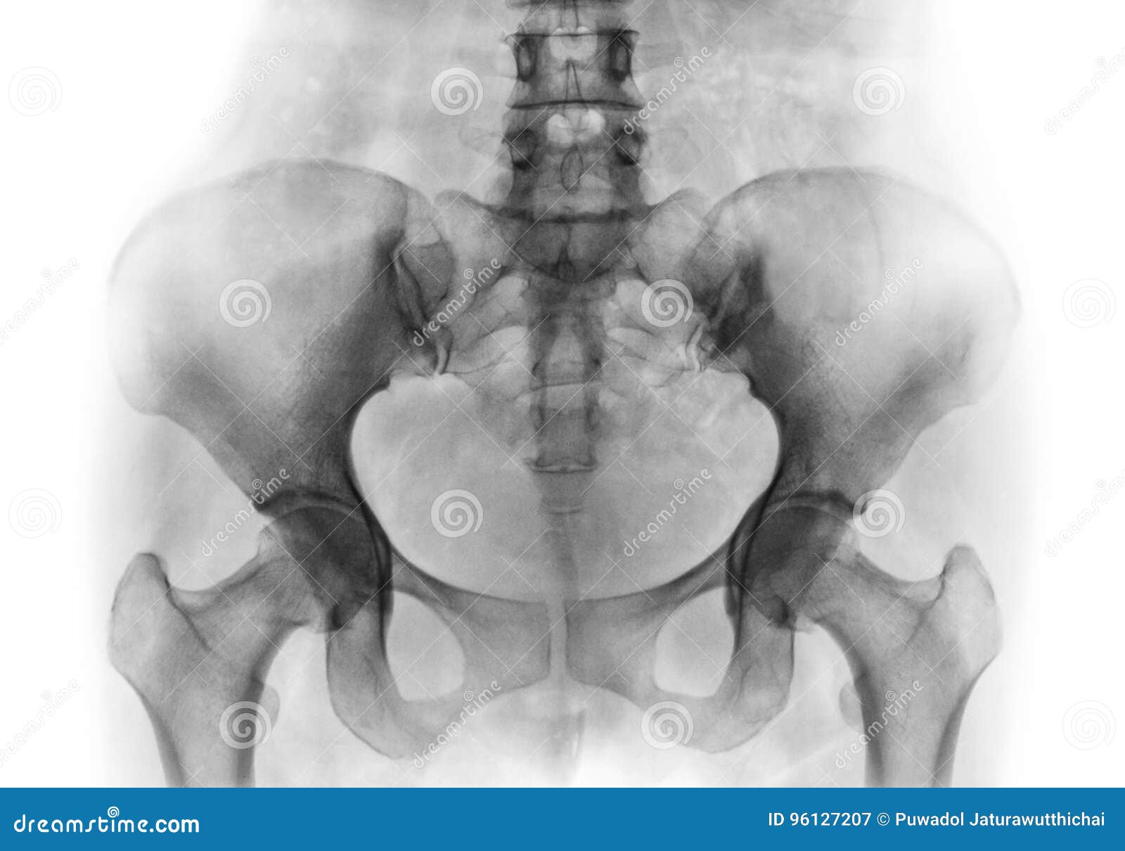 Film X-ray of Normal Human Pelvis and Hip Joints Stock Image - Image of ...