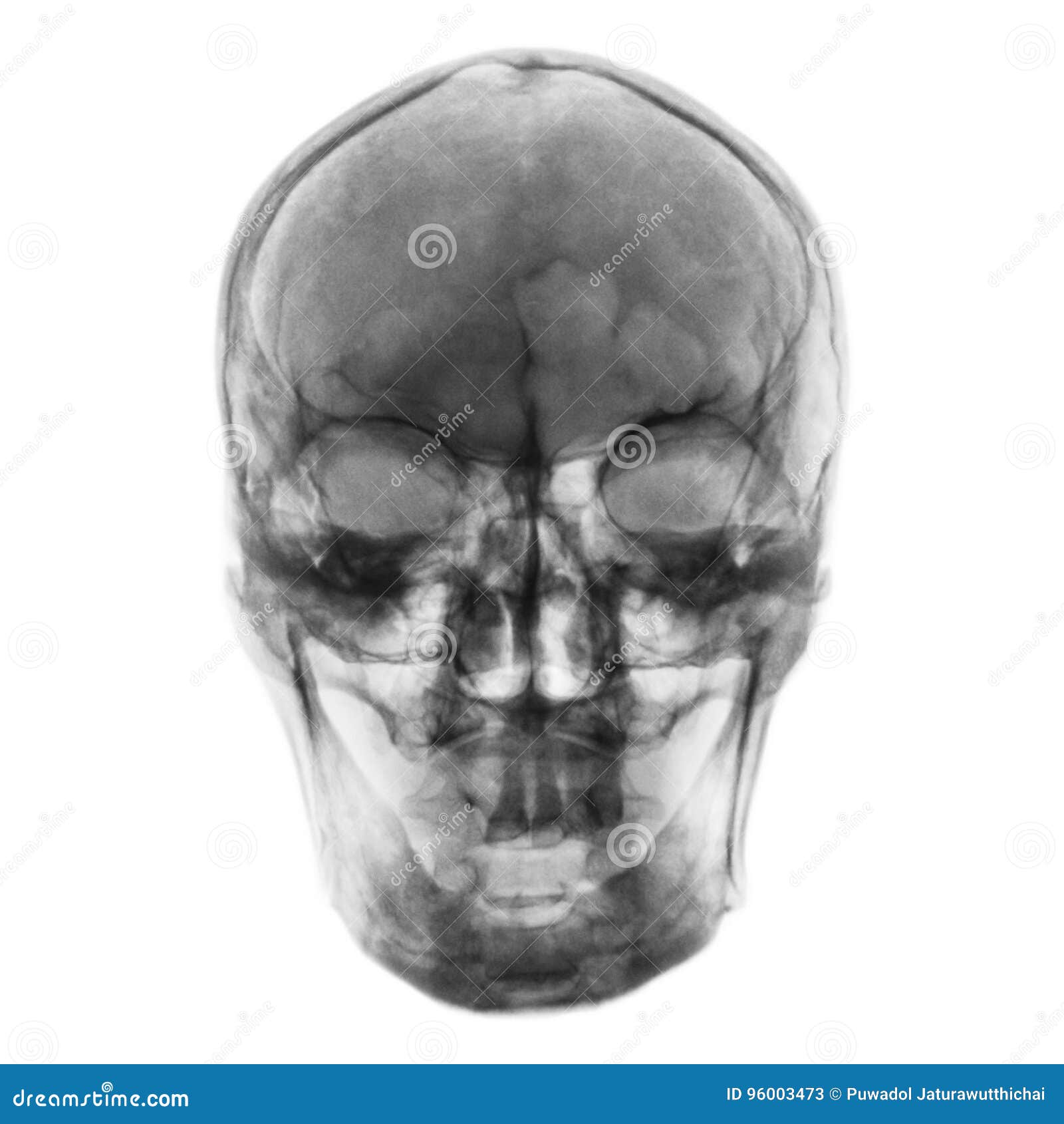 Film X-ray of Normal Human Skull . Front View Stock Image - Image of ...