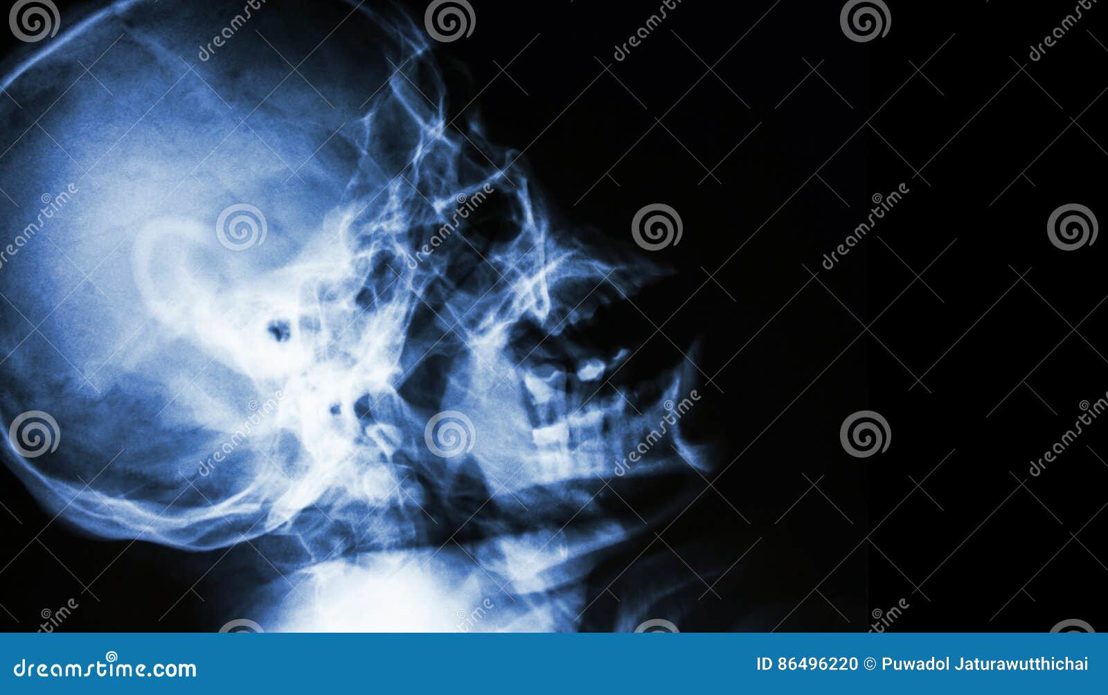 Film X-ray of Normal Human Skull . Lateral View . Blank Area at Right ...