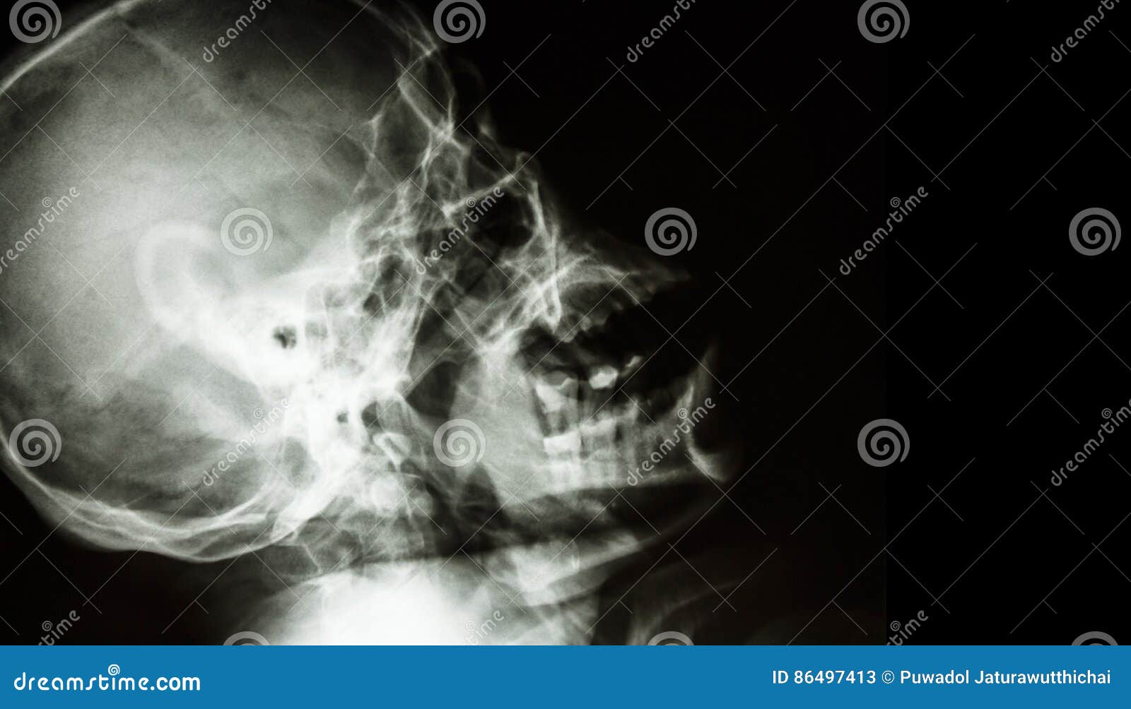 Human Skull Right Side View