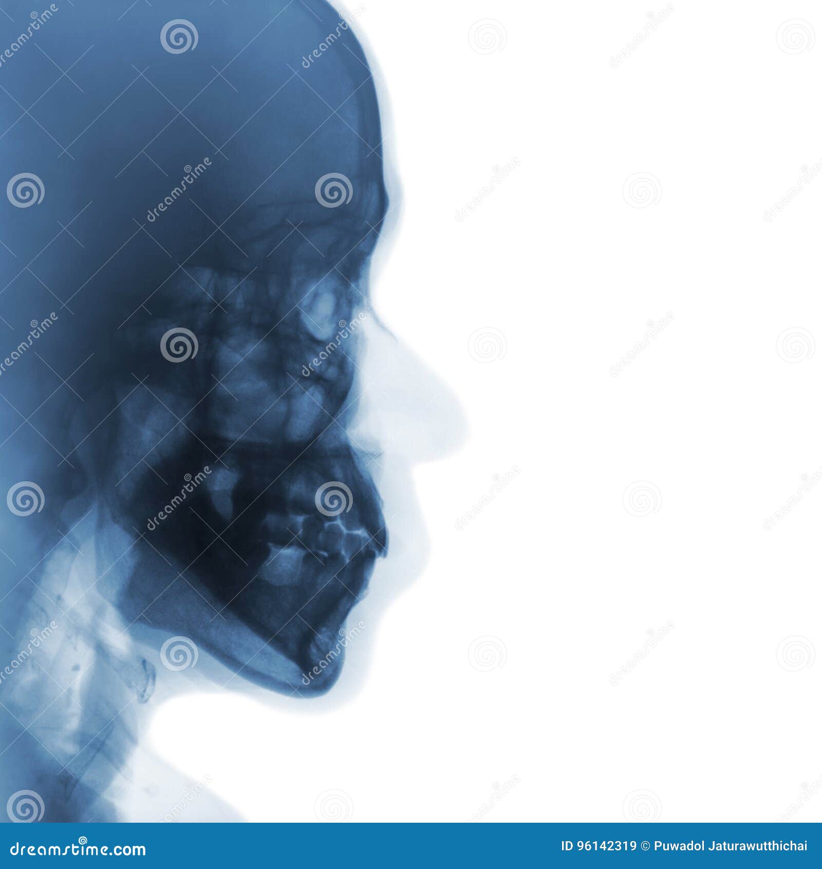 Film X-ray of Normal Human Skull . Lateral View Stock Image - Image of ...