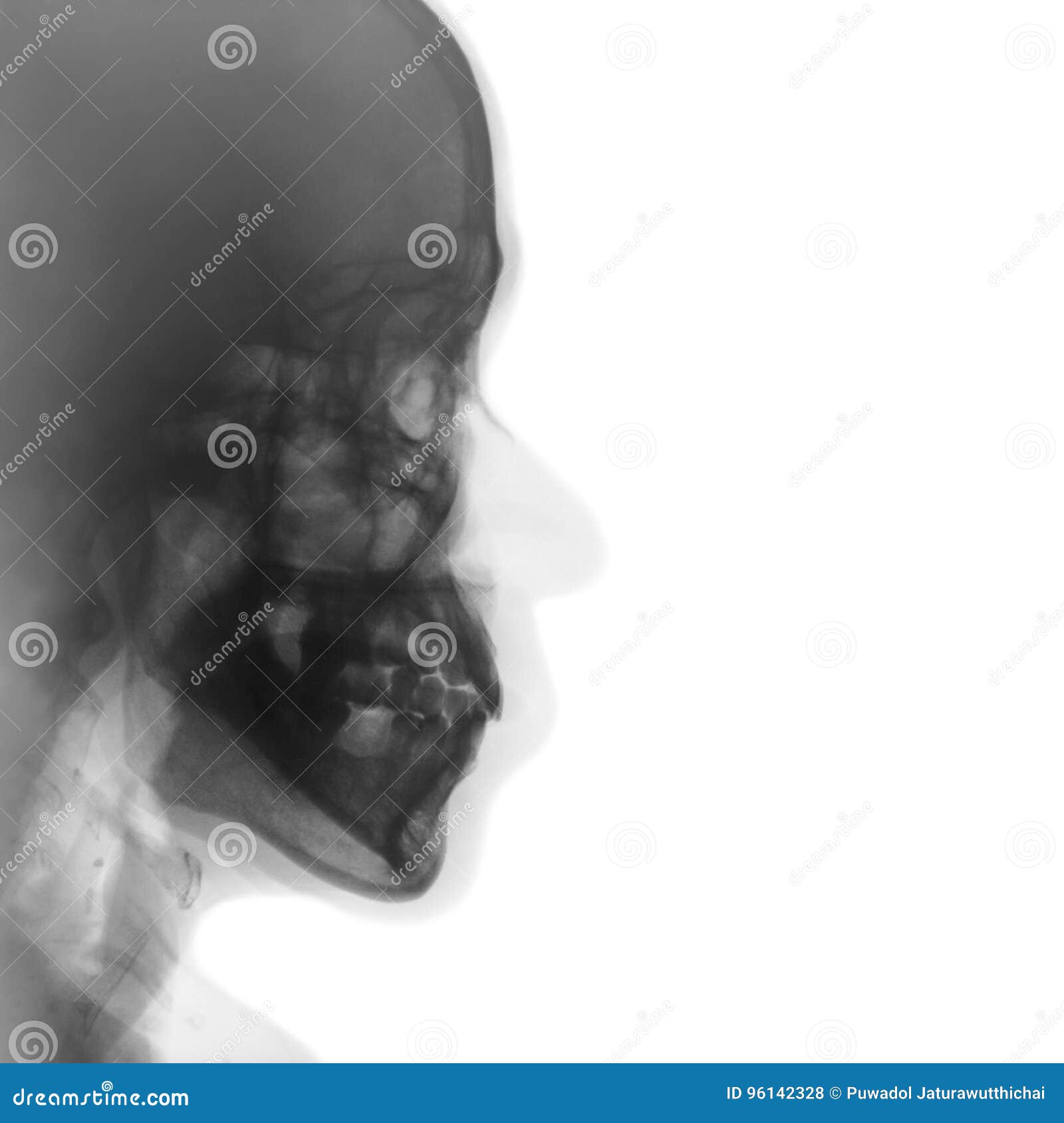 Film X-ray of Normal Human Skull . Lateral View Stock Photo - Image of ...