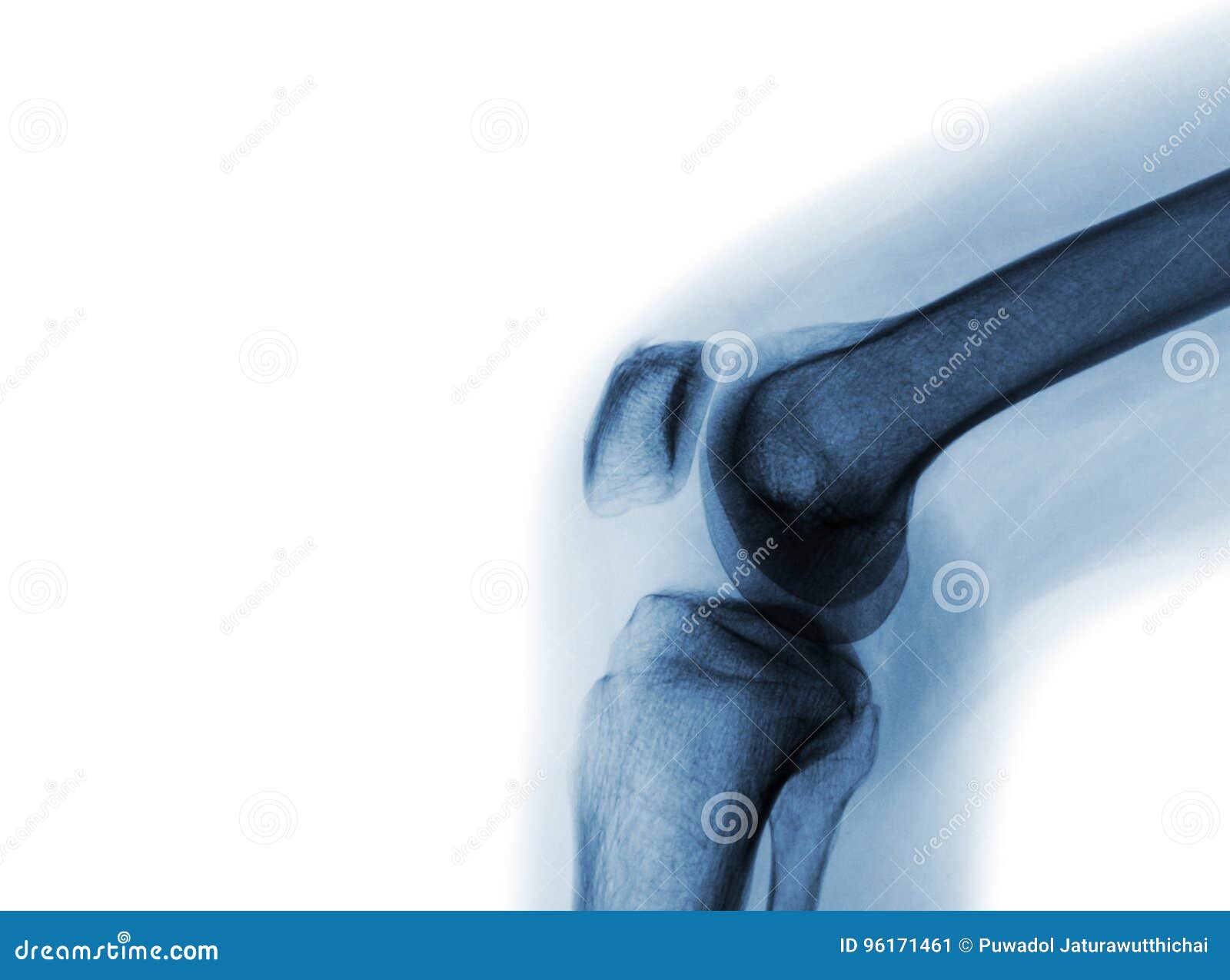 Film X-ray of Normal Knee Joint Stock Image - Image of imaging, normal ...