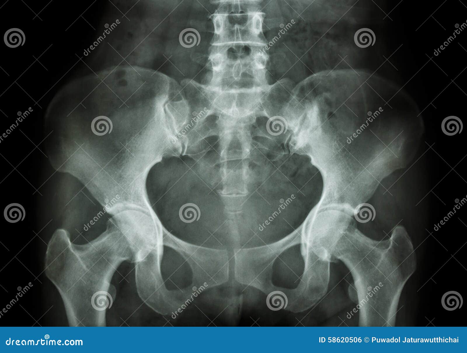 Film X-ray of Pelvis stock photo. Image of breech, normal - 58620506