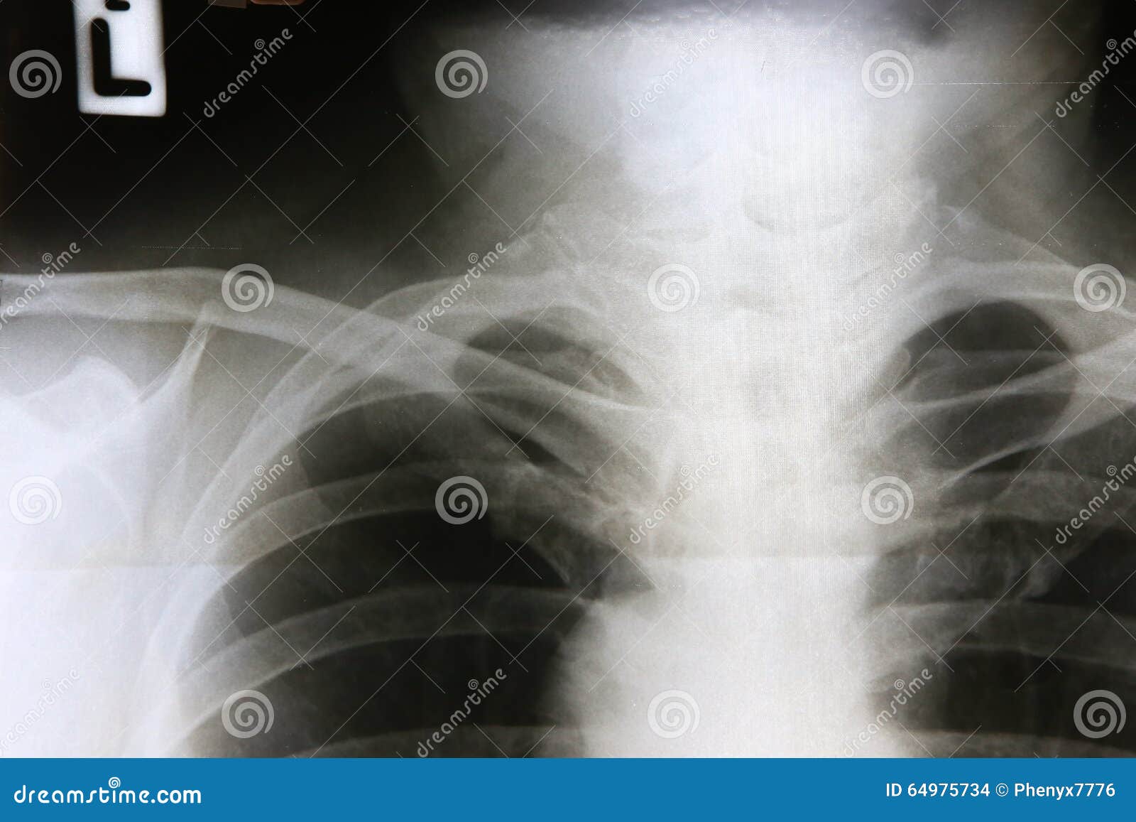 Film x-ray right clavicle stock photo. Image of abdomen - 64975734
