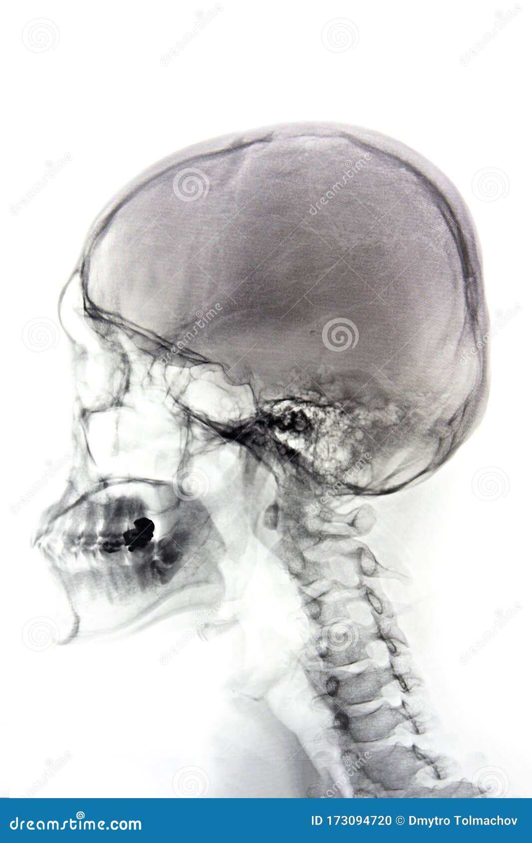 Film X-ray Skull and Cervical Spine Stock Photo - Image of doctor ...