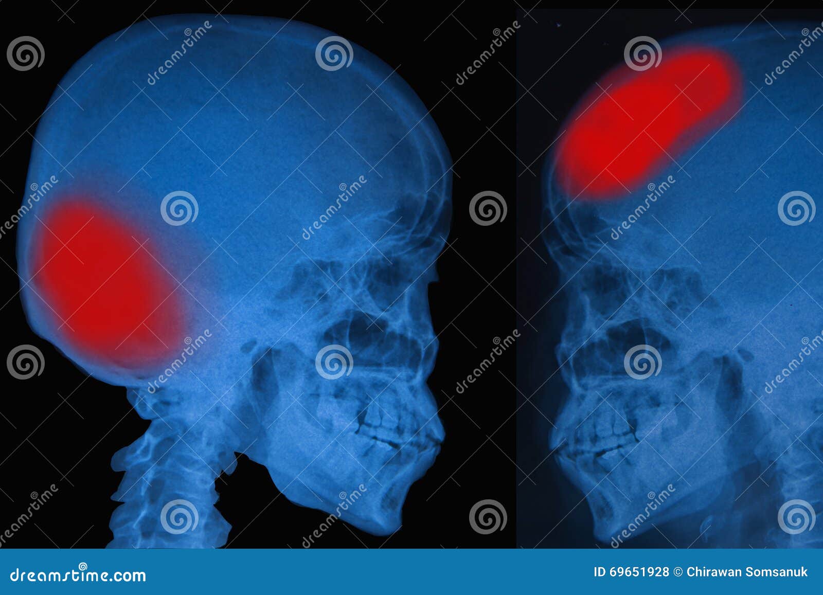 Film x-ray skull of human stock photo. Image of imaging - 69651928
