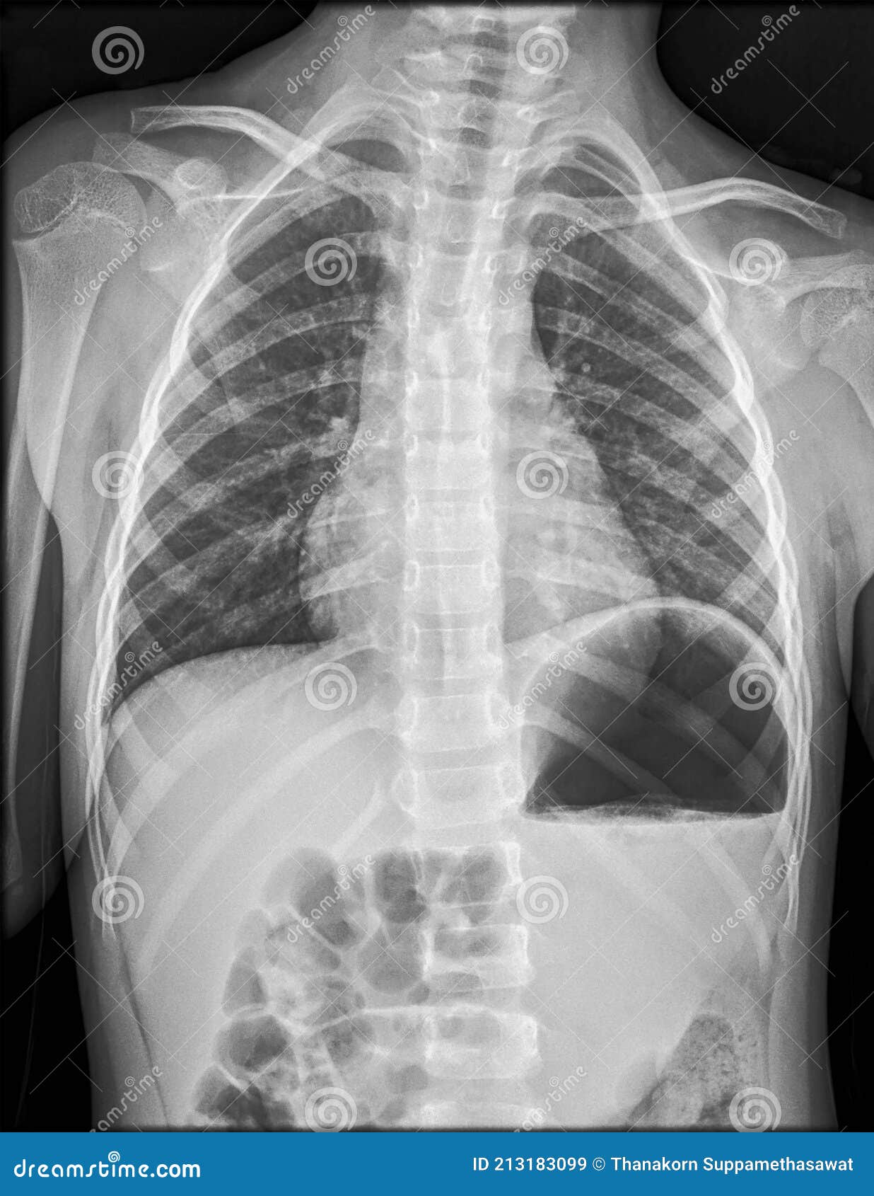 Normal Child Chest X Ray