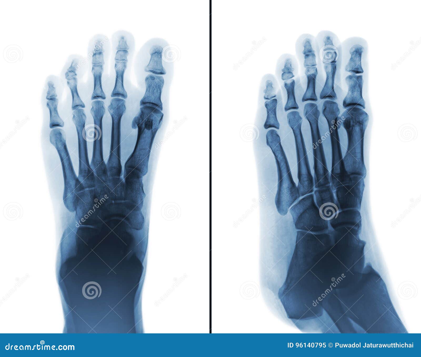 X-ray Normal Human Foot . Lateral View . Invert Color Style Royalty ...