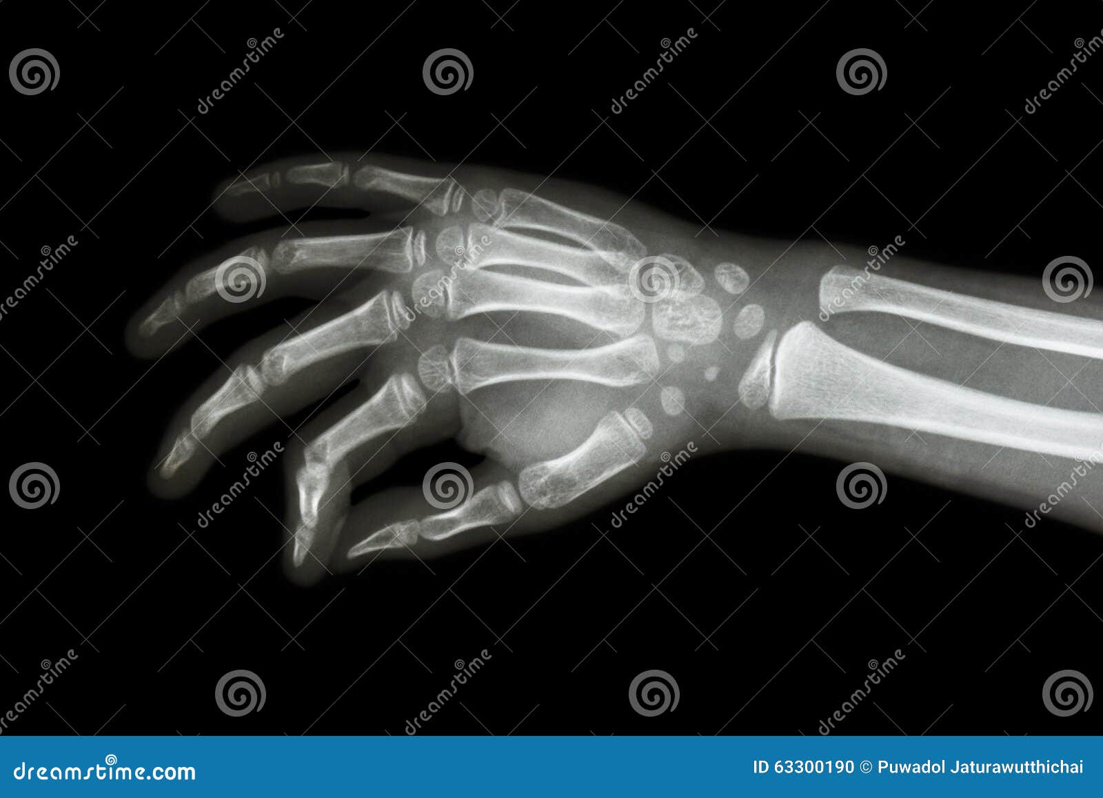Film X-ray Hand Of Child ( Oblique View ) Stock Photo - Image: 63300190