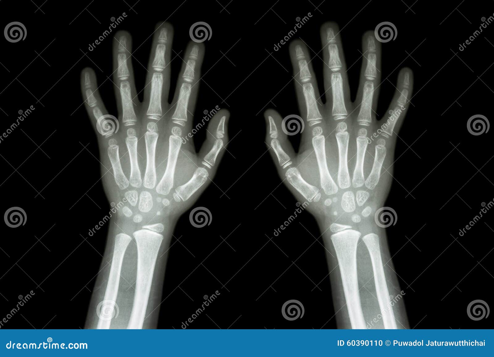 Film X-ray Of Normal Child Ankle . Lateral View Royalty-Free Stock ...