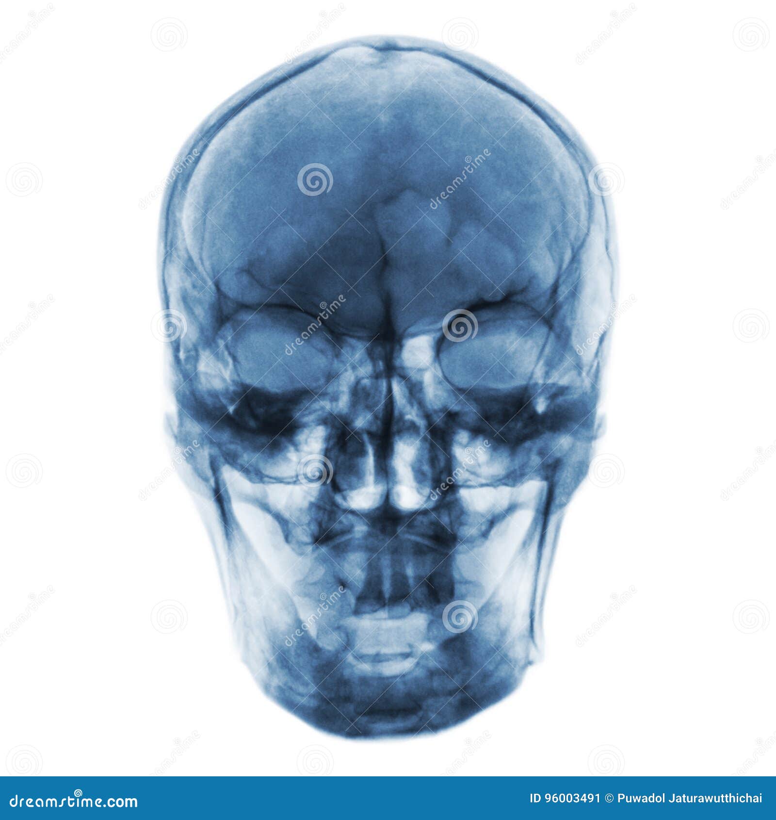 X-ray Normal Skull And Cervical Spine . Lateral View . Invert Color ...