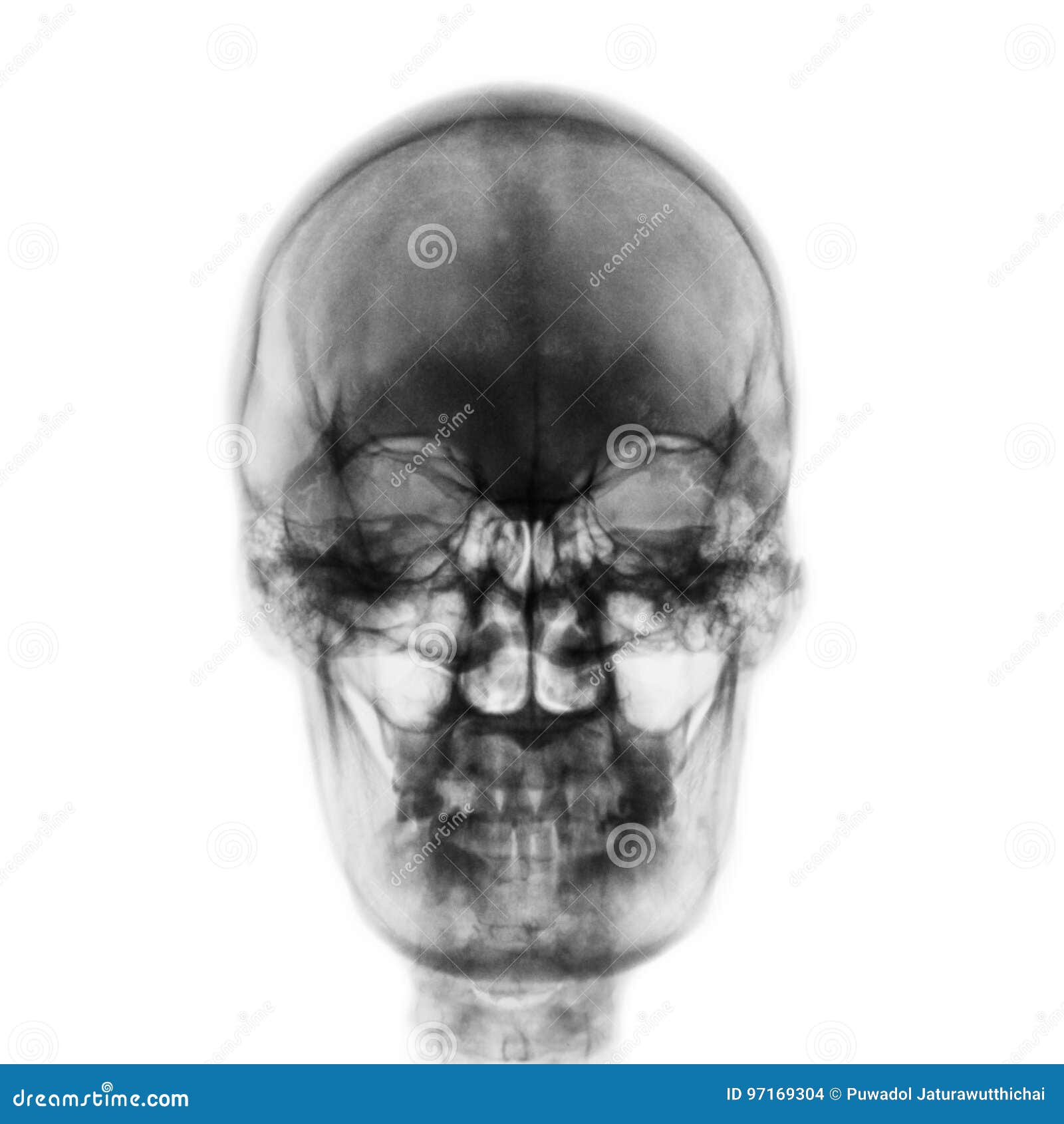 X-ray Normal Human Foot . Lateral View . Invert Color Style Royalty ...