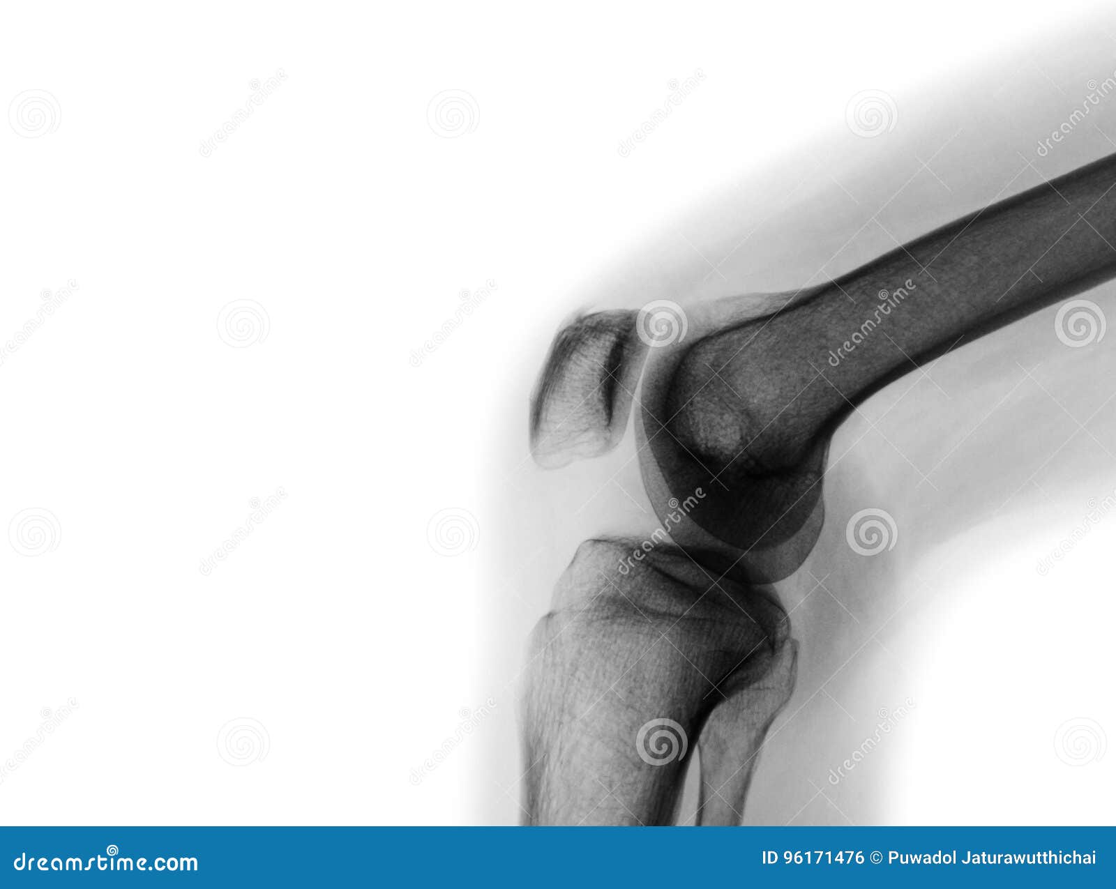 Film X-ray Of Normal Child Ankle . Lateral View Royalty-Free Stock ...