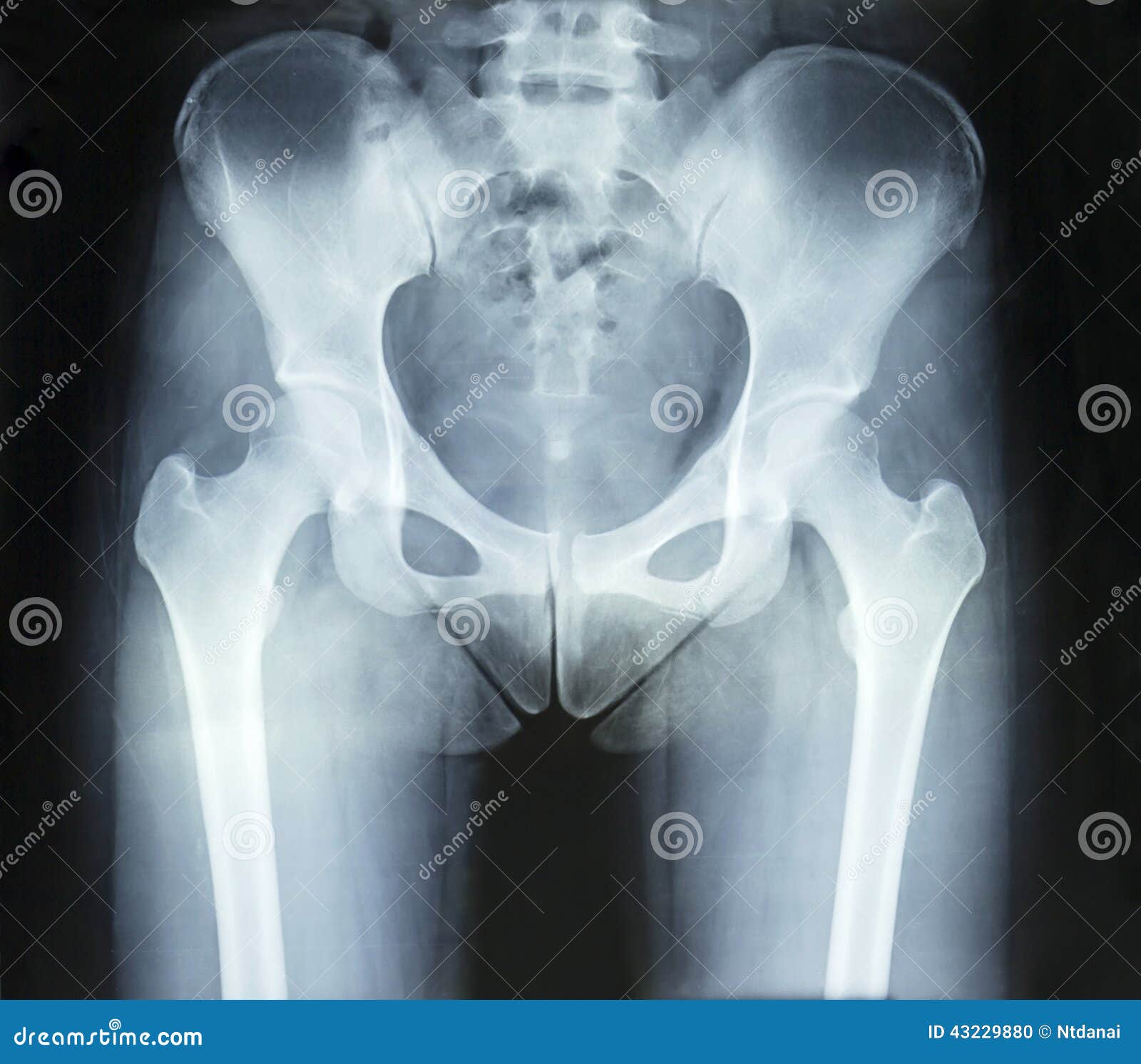 Normal Pelvis & Hip Joint Royalty-Free Stock Photography ...