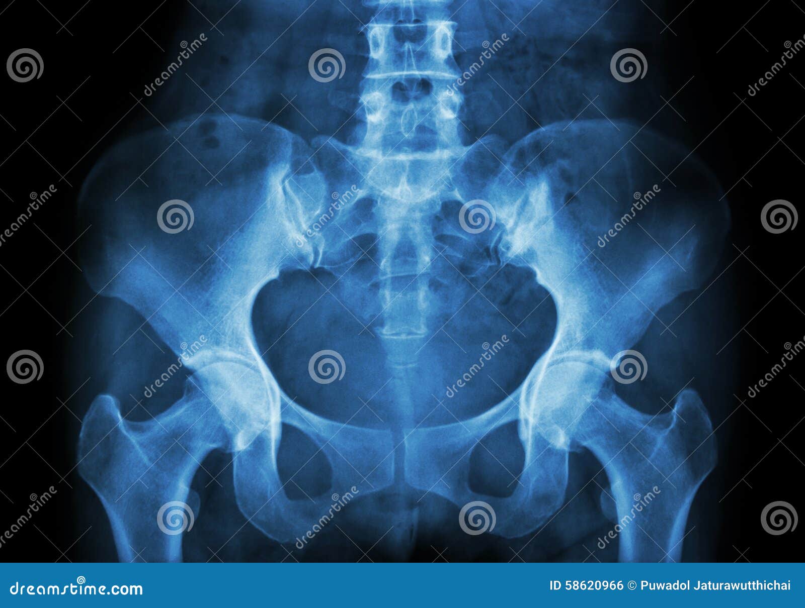 Normal Pelvis & Hip Joint Royalty-Free Stock Photography ...