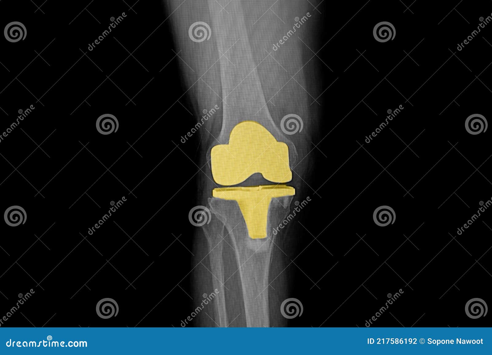 A Film Xray of a Knee of a Patient after Total Knee Prosthesis ...