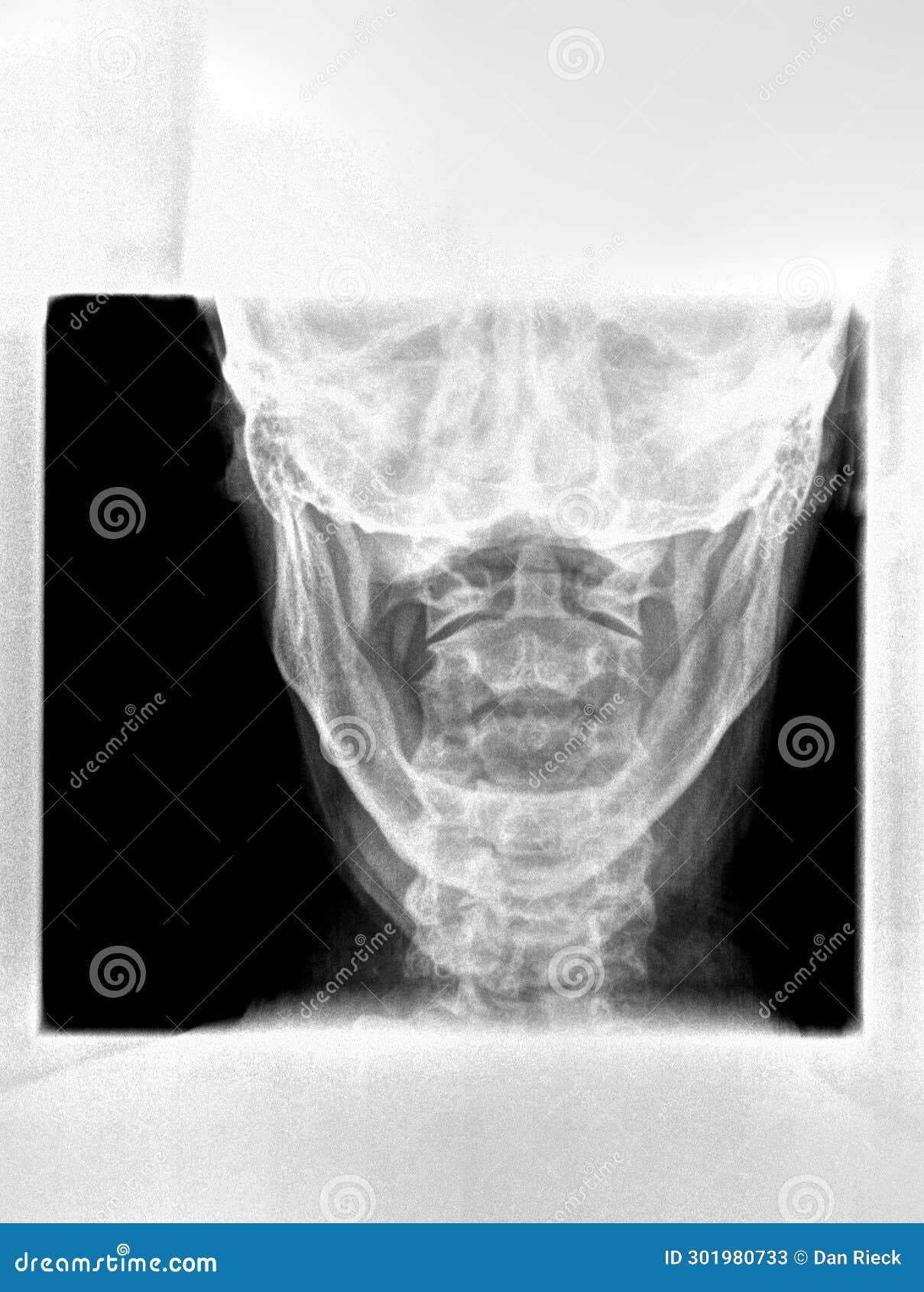 Film Xray or Radiograph of a Cervical Neck. AP Open Mouth Anterior ... Film Xray or Radiograph of a Cervical Neck. AP Open Mouth Anterior ...