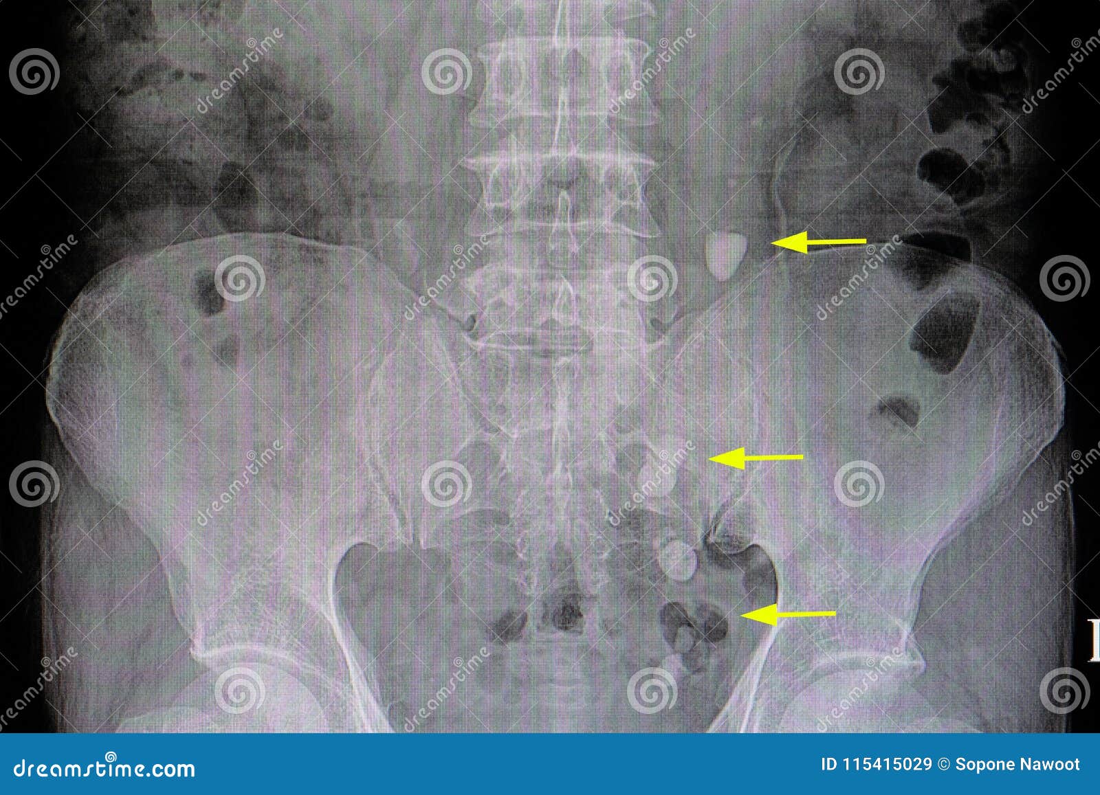 Filme De Raio X De Um Paciente Com Pedras Ureteric Imagem de Stock ...