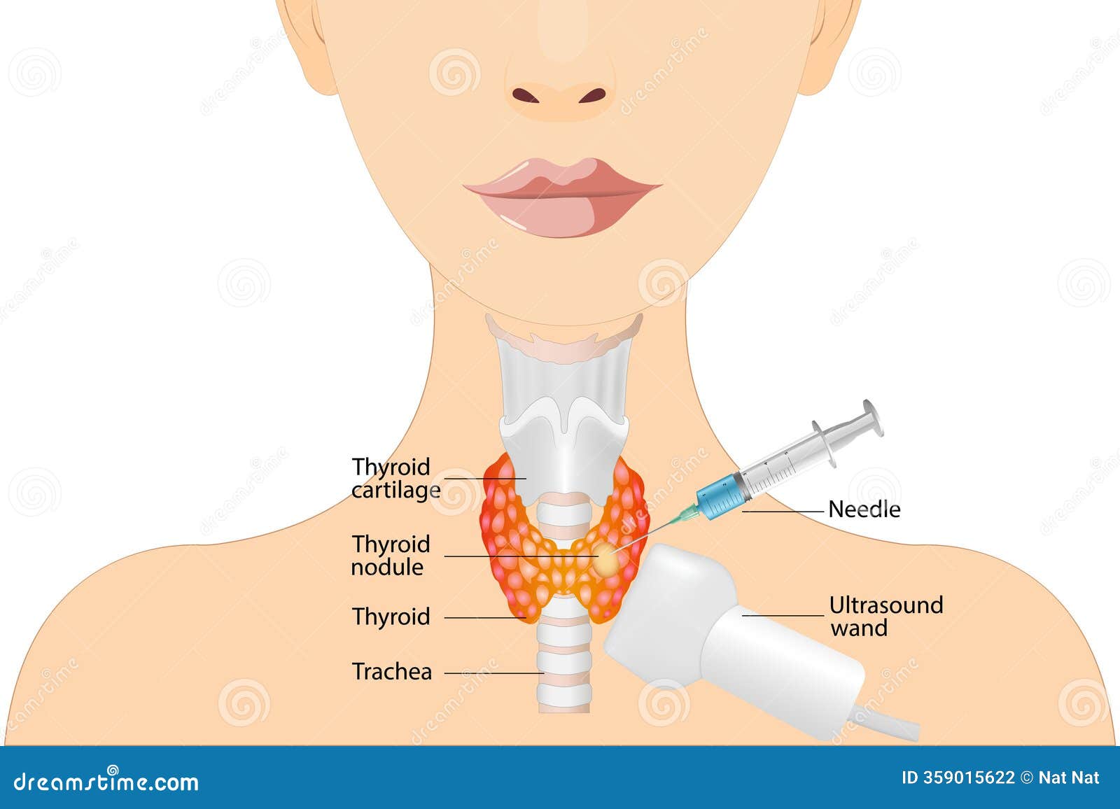 Fine Needle Aspiration Biopsy of the Thyroid Gland in a Patient Using ...