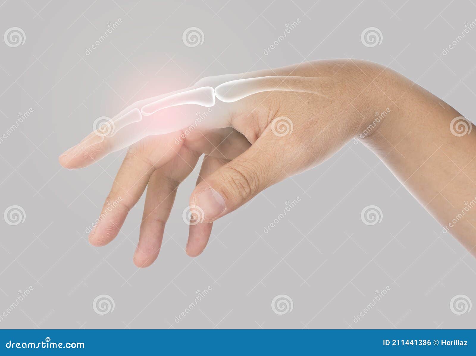 Finger bone pain stock photo. Image of healthcare, orthopedic - 211441386