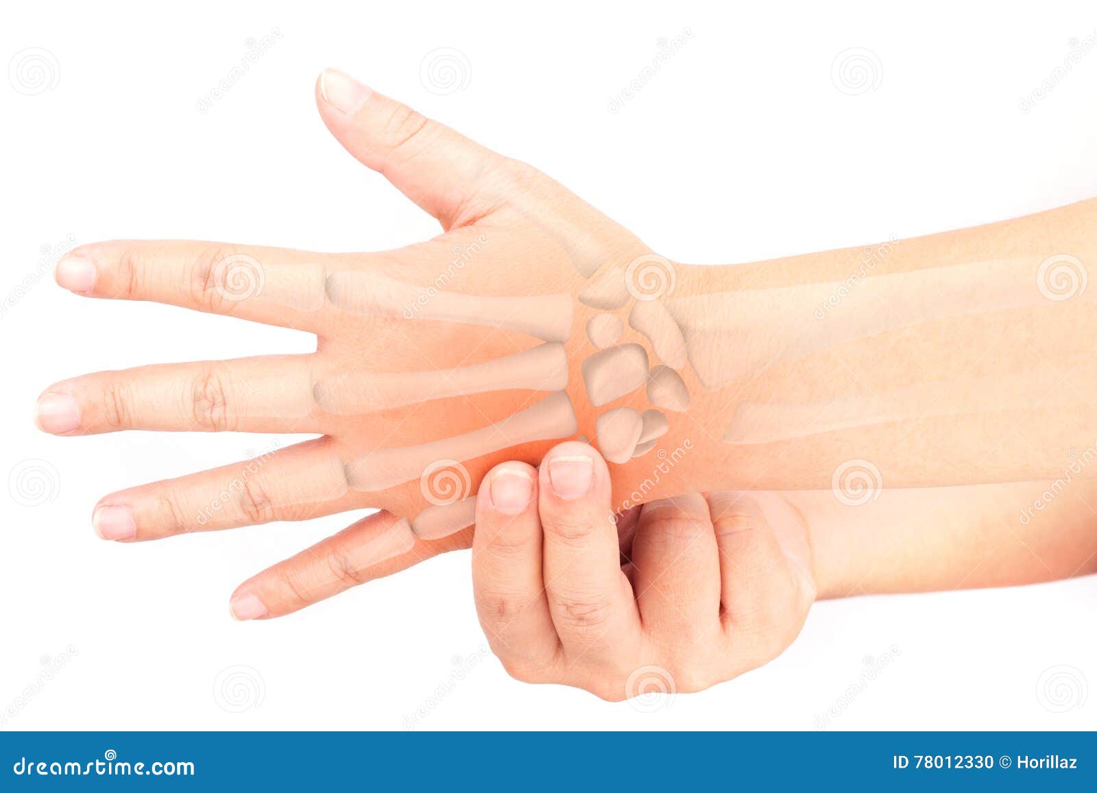 Finger bone pain stock photo. Image of illness, phalanges - 78012330