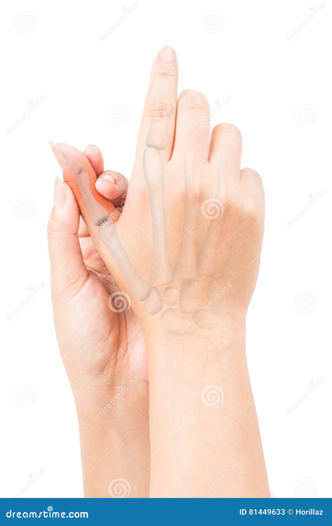 Finger bone pain stock image. Image of orthopedic, motion - 81449633