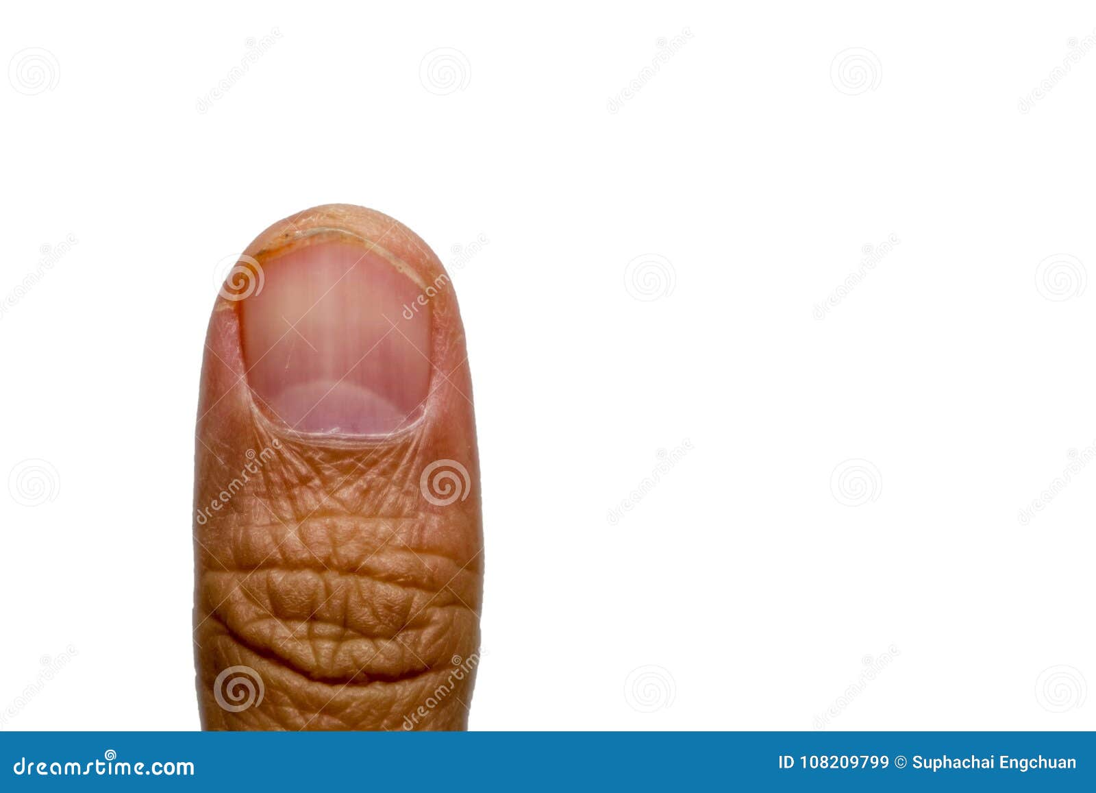 Finger Disease. Hematoma. Toe Injury. Bruise And Trauma Treatment ...