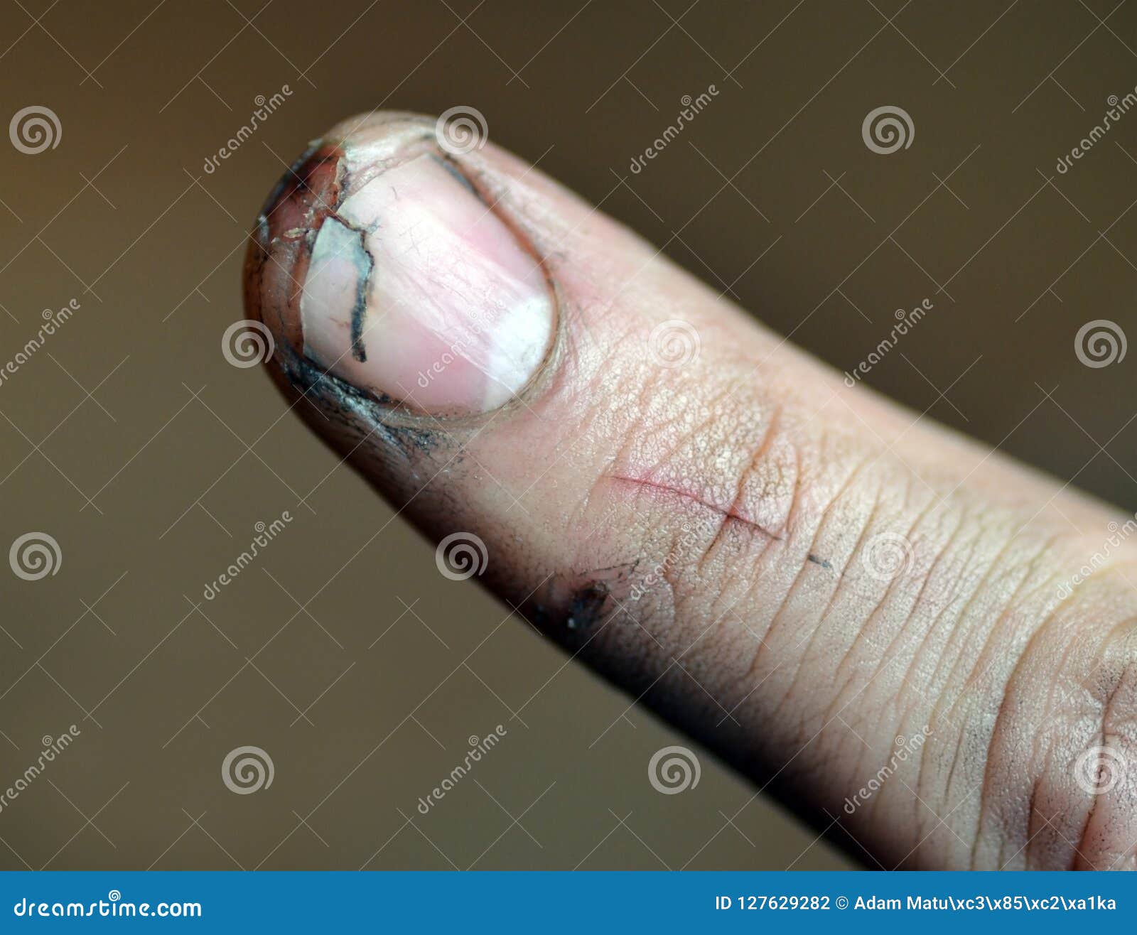 Finger Herido, Primer Dedo Humano Foto de archivo - Imagen de corte ...
