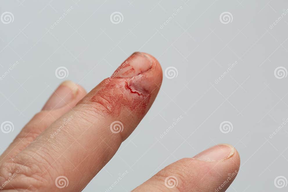 Finger injury stock photo. Image of hand, injury, treatment - 46526794