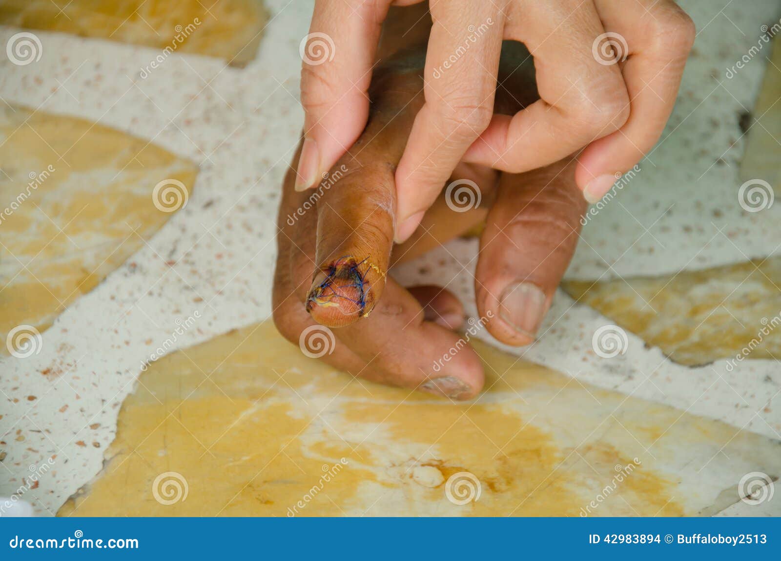 Finger injury stock photo. Image of person, bandaid, healthcare - 42983894