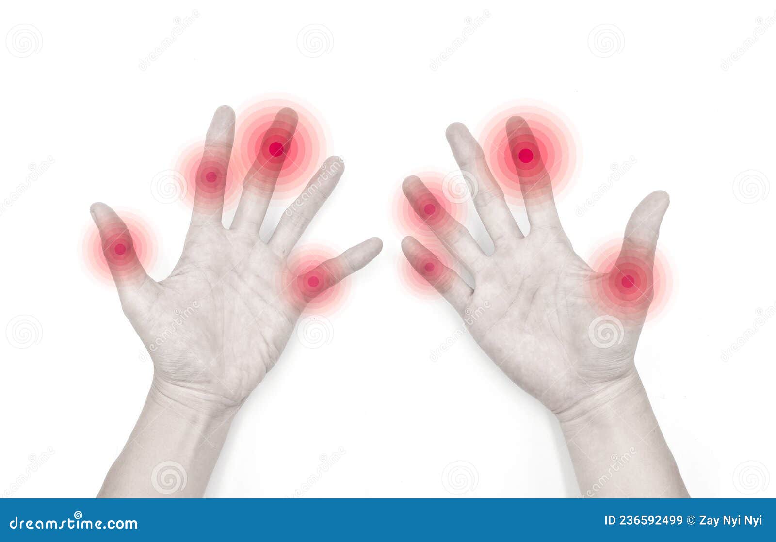 Finger Joints Inflammation. Concept of Rheumatic Arthritis, Imgrating ...
