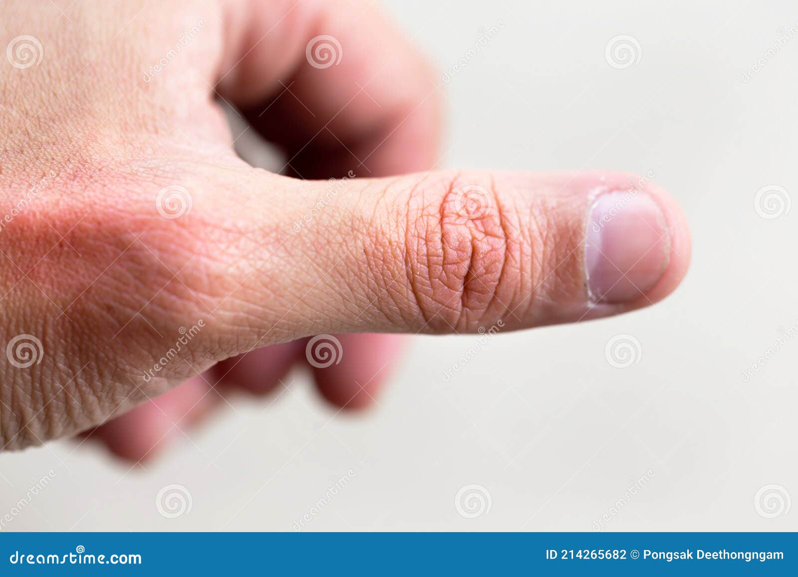 Finger Pain with Severe Gout Stock Photo - Image of joint ...