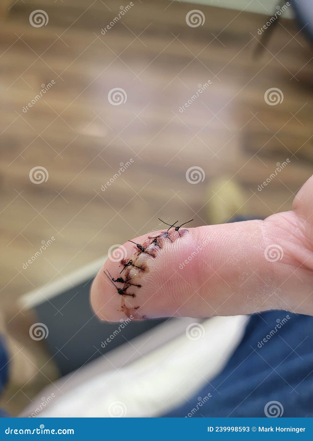 Finger with stitches stock image. Image of injury, finger - 239998593