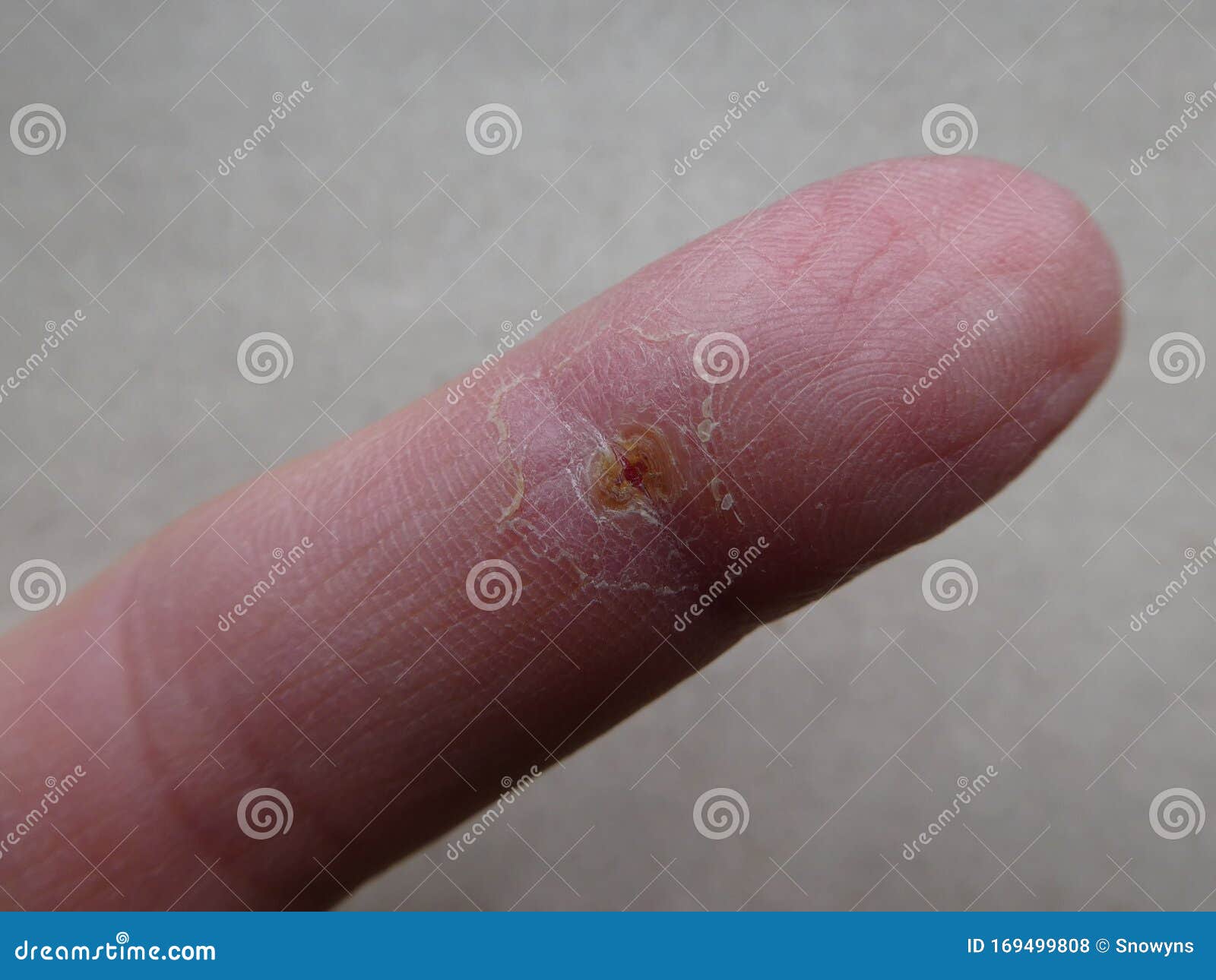 Finger with Wound from Injured after Skin Burn Stock Photo - Image of ...