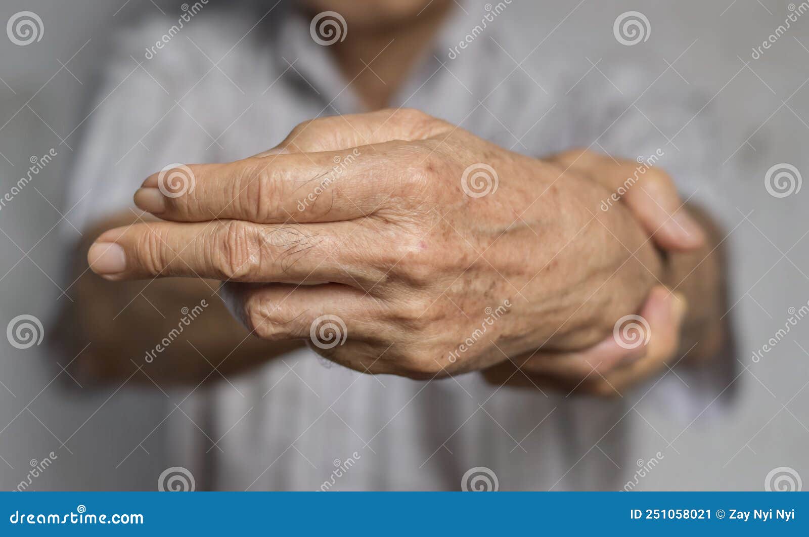 Fingers Rigidity, Hand Muscles Spasm, or Weakness of Digits Stock Image ...