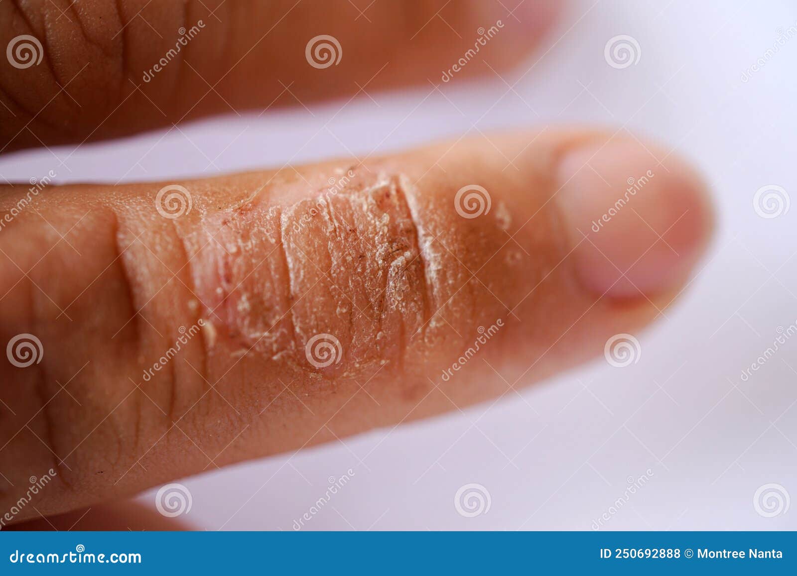 Fingertip Dermatitis