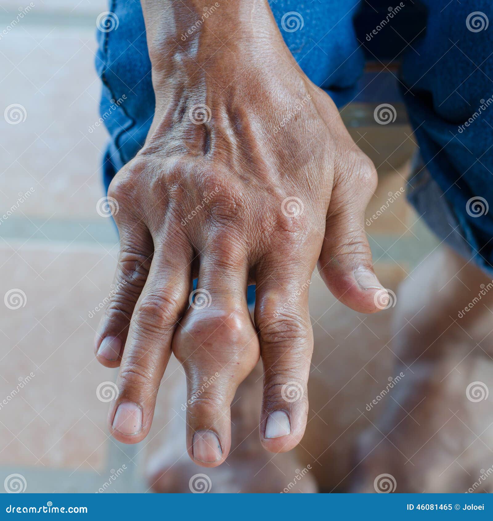 Fingrar av patienter fotografering för bildbyråer. Bild av hand - 46081465