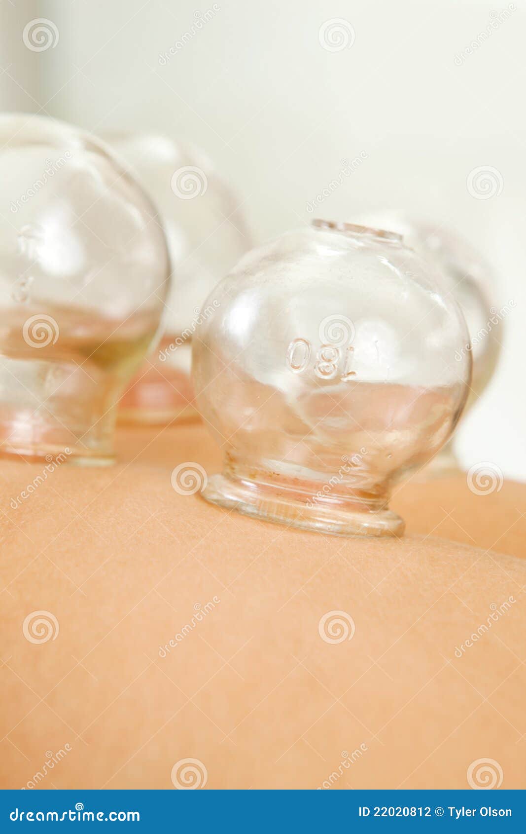 Fire Cupping Detail stock photo. Image of female, body - 22020812