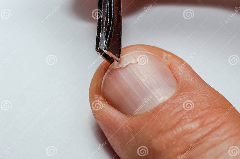 First Aid for a Patient with a Broken Fingernail Stock Photo - Image of ...