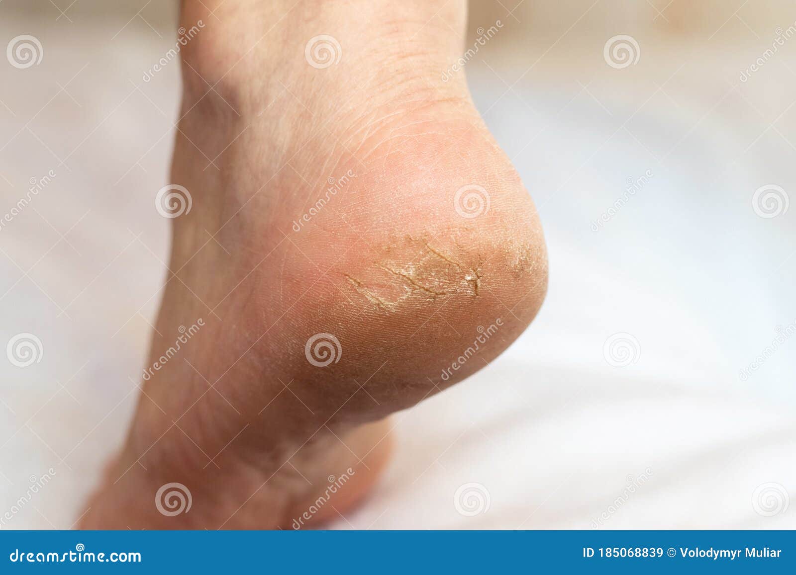 Fissuras No Calcanhar. Cuidados De Pele E Tratamento Imagem de Stock ...